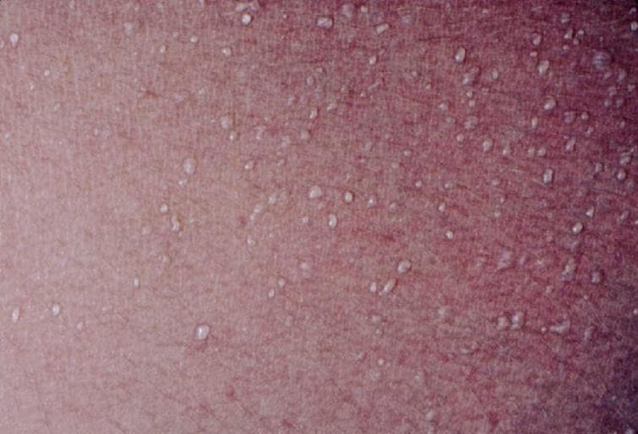 6 Common-to-Rare Infant Skin Conditions