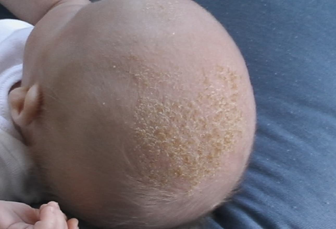 6 Common-to-Rare Infant Skin Conditions