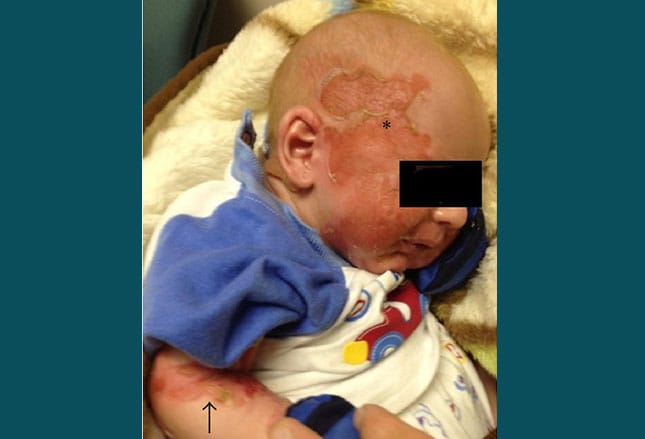 6 Common-to-Rare Infant Skin Conditions