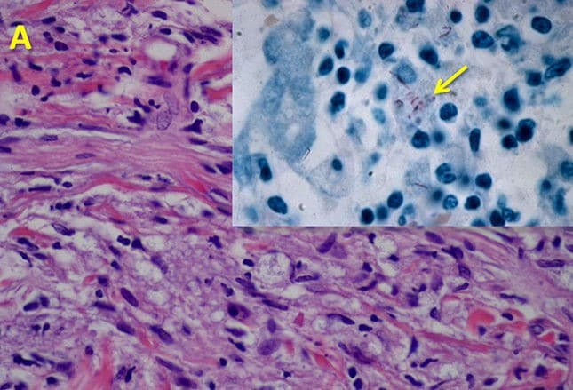 Bacterial Skin Infections: Can You Make the Diagnosis?