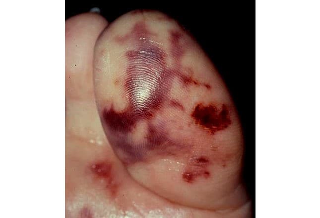 Bacterial Skin Infections: Beneath the Surface