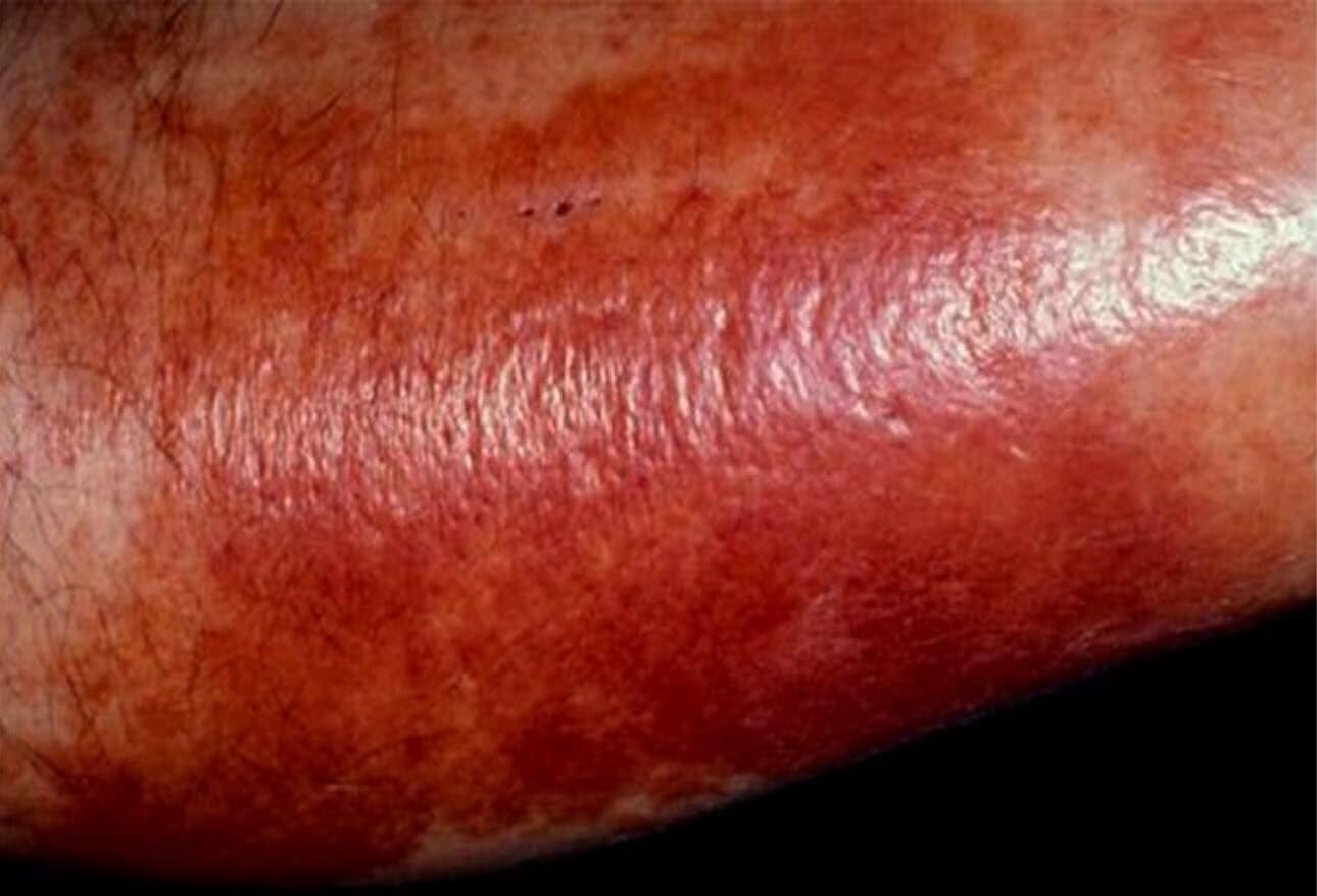 Skin infection store