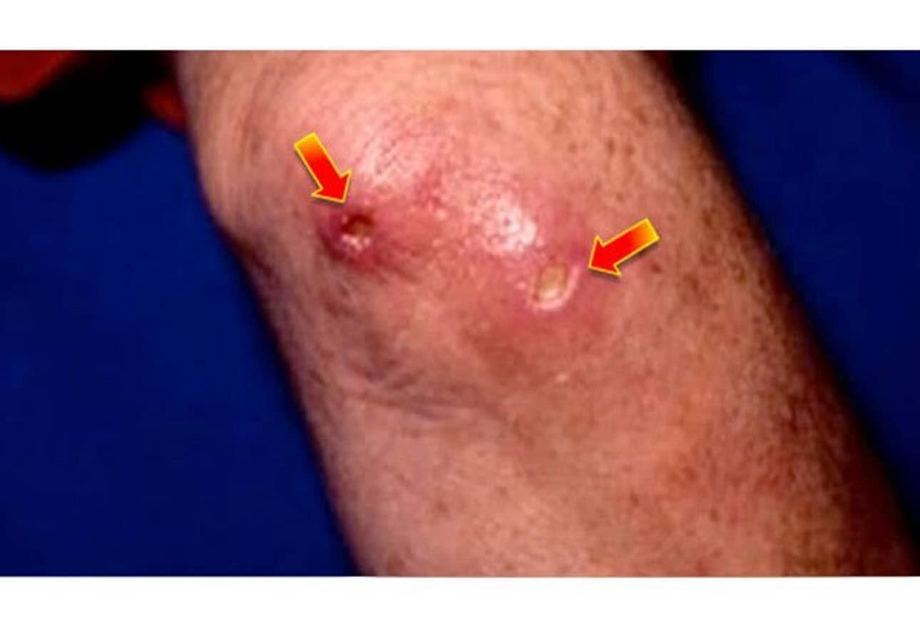 Bacterial Skin Infections: Beneath the Surface