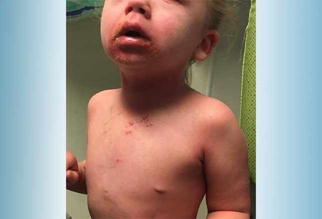 Bacterial Skin Infections: Beneath the Surface