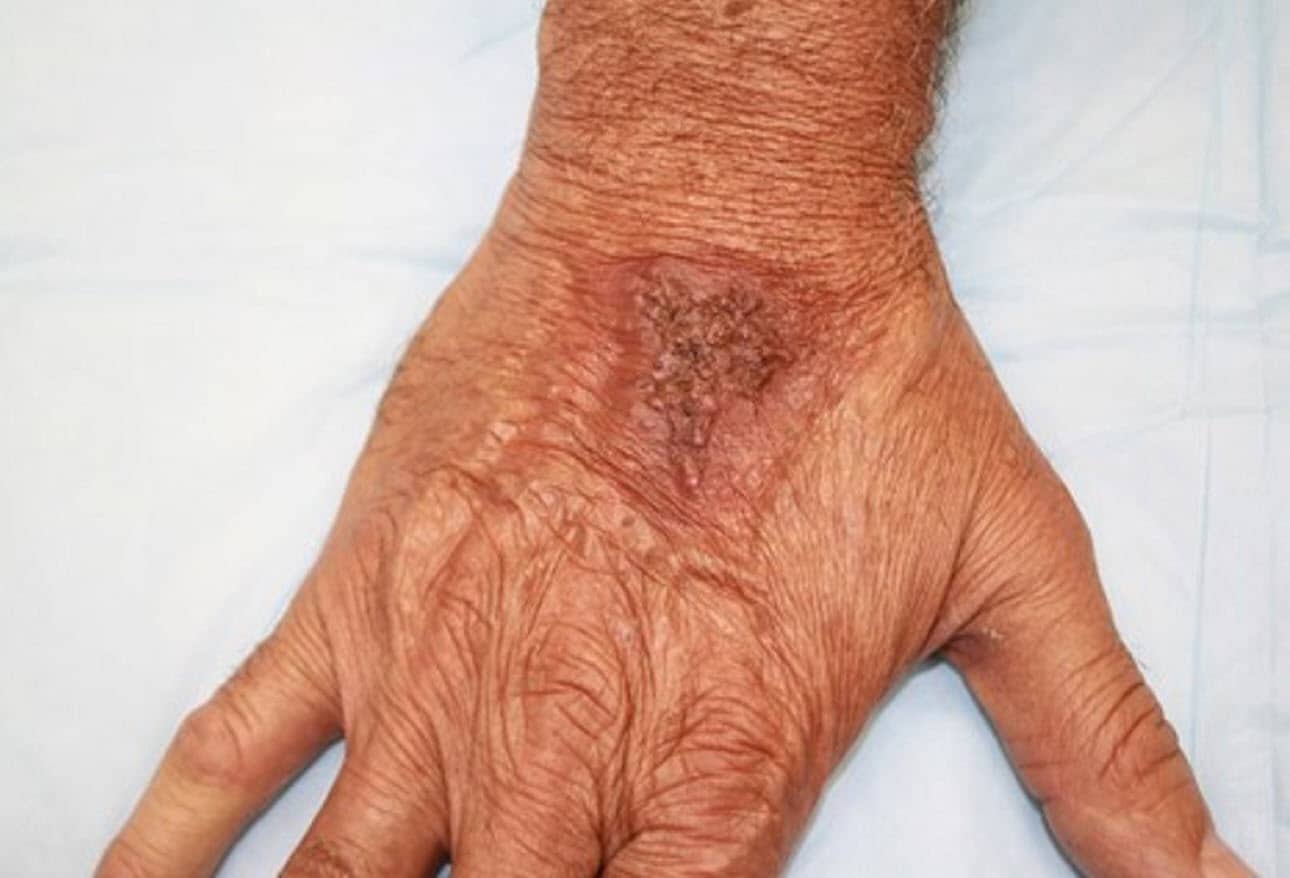 Bacterial Skin Infections: Beneath the Surface