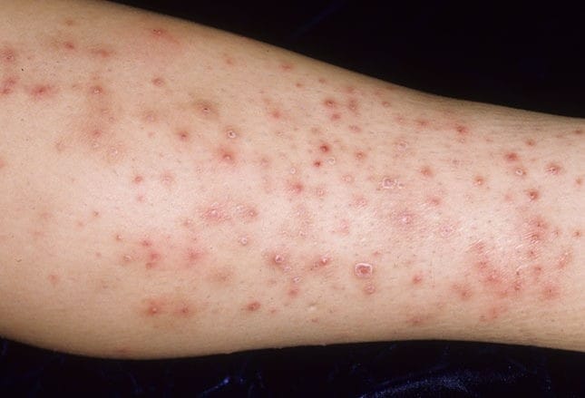 Bacterial Skin Infections: Can You Make the Diagnosis?