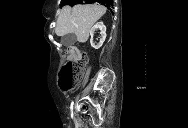 Intestinal Obstruction, Pseudo-obstruction, and Ileus: Blockage ...