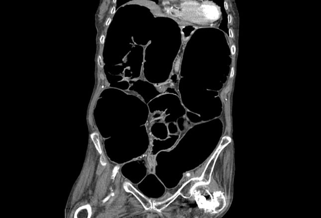 Intestinal Obstruction, Pseudo-obstruction, and Ileus: Blockage ...