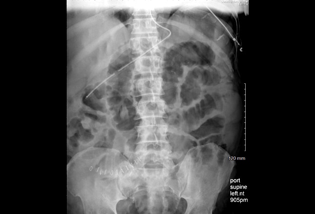 Intestinal Obstruction, Pseudo-obstruction, and Ileus: Blockage ...