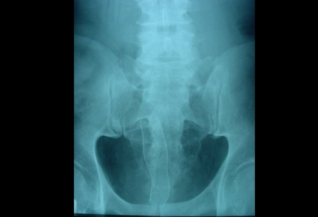 Intestinal Obstruction, Pseudo-obstruction, and Ileus: Blockage ...