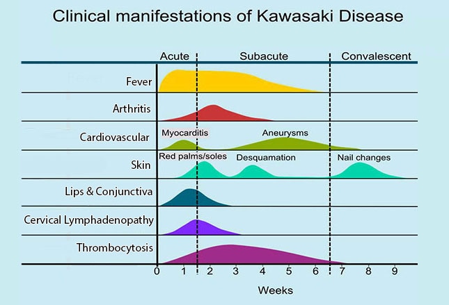 Kawasaki Disease: Do You Know the Signs?