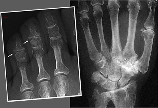 Notable Knuckles: Evaluating Arthritic Conditions of the Hand