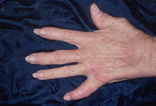 Notable Knuckles: Evaluating Arthritic Conditions of the Hand