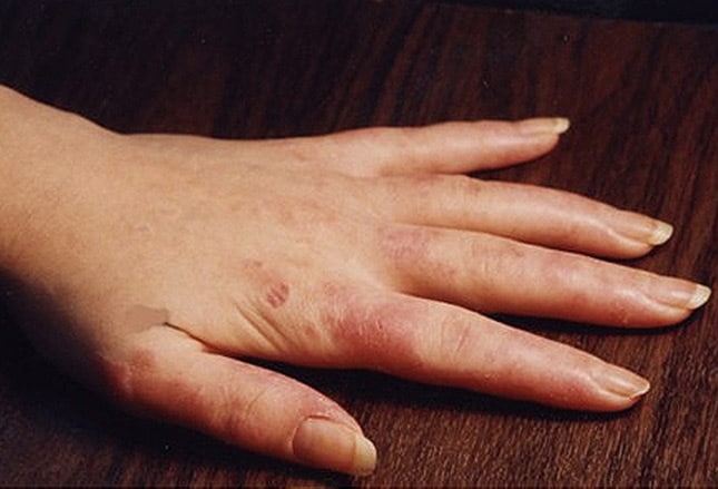 Notable Knuckles: Evaluating Arthritic Conditions of the Hand