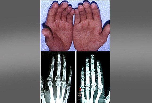 Notable Knuckles: Evaluating Arthritic Conditions of the Hand