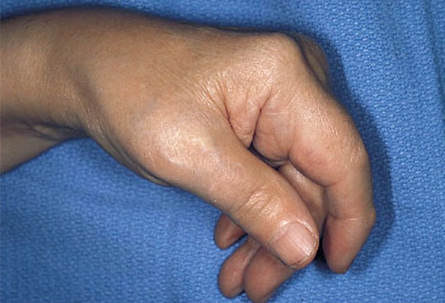 Notable Knuckles: Evaluating Arthritic Conditions of the Hand