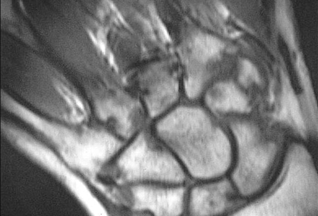 Notable Knuckles: Evaluating Arthritic Conditions of the Hand