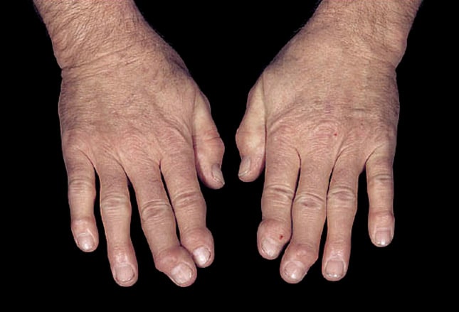 Notable Knuckles: Evaluating Arthritic Conditions of the Hand