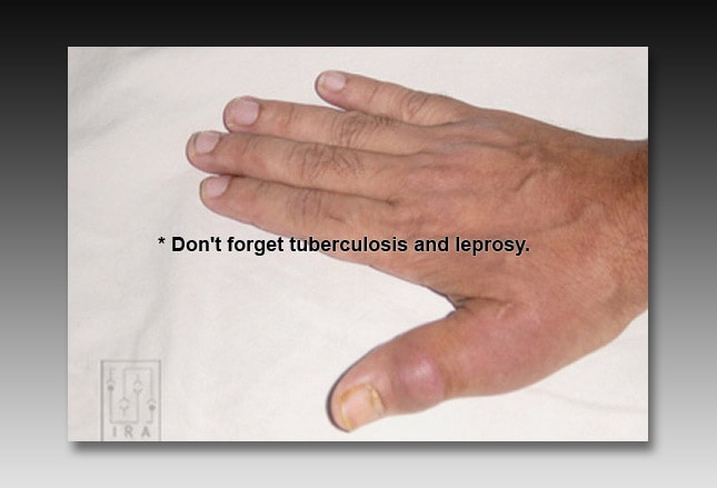 Notable Knuckles, Part 2: Evaluating More Conditions of the Hand