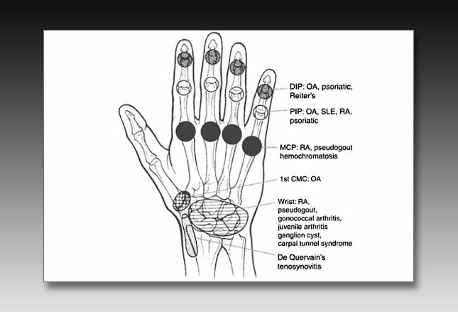 Notable Knuckles, Part 2: Evaluating More Conditions of the Hand