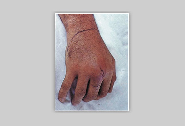 Notable Knuckles, Part 2: Evaluating More Conditions of the Hand