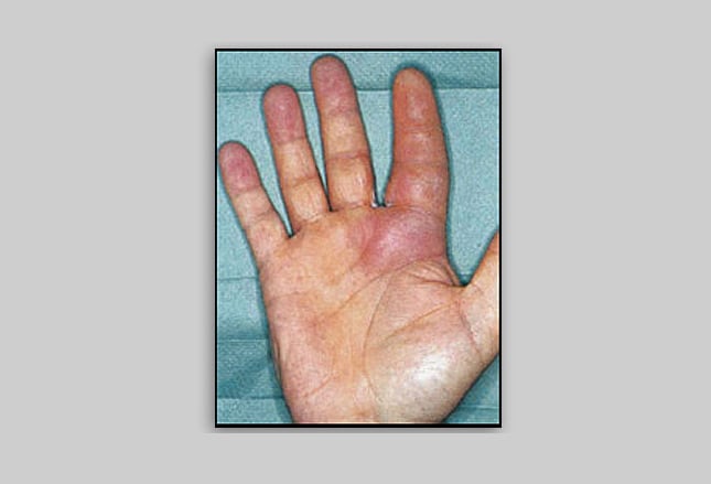 Notable Knuckles, Part 2: Evaluating More Conditions of the Hand