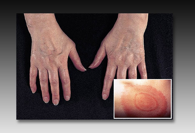 Notable Knuckles, Part 2: Evaluating More Conditions of the Hand