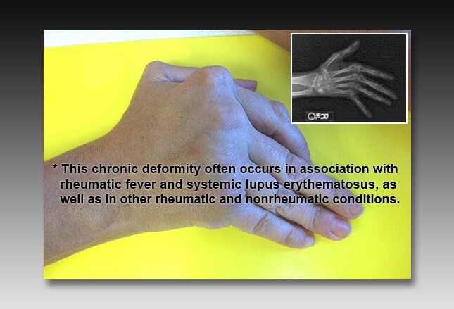 Notable Knuckles, Part 2: Evaluating More Conditions of the Hand