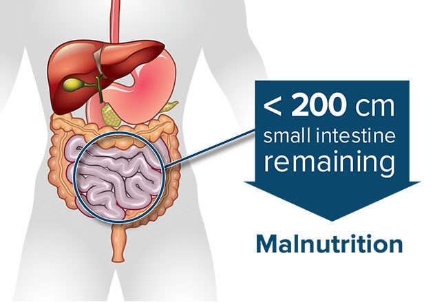 Malnutrition: Causes, Complications, and Treatments