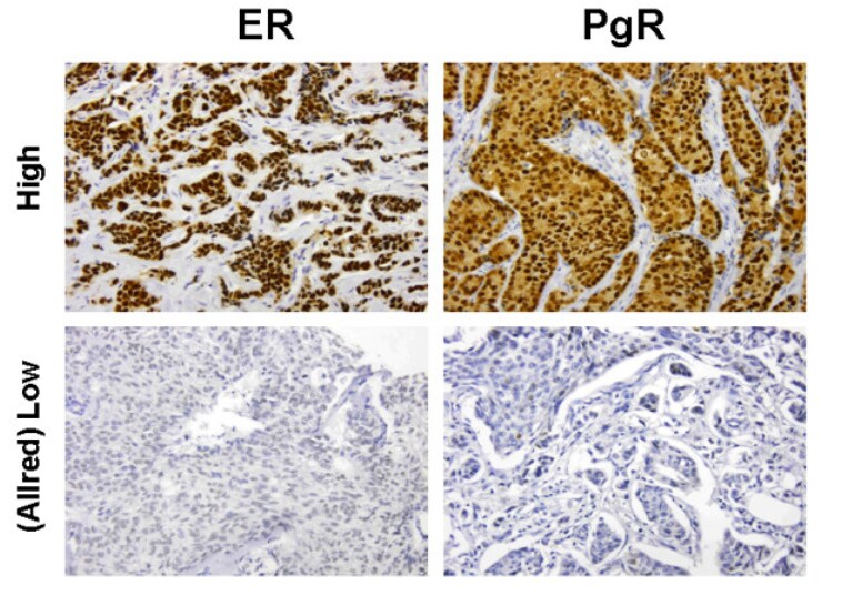 Metastatic Breast Cancer: Current and Emerging Treatments