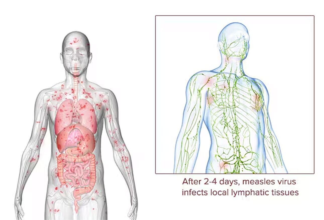 Measles: More Than Just a Rash