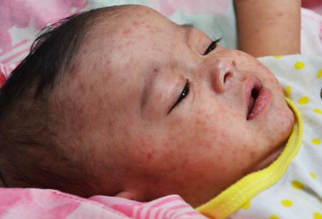 Measles: More Than a Rash
