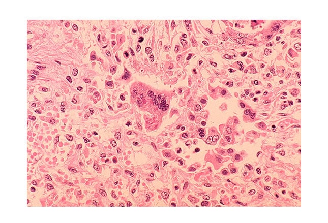 Measles: More Than a Rash