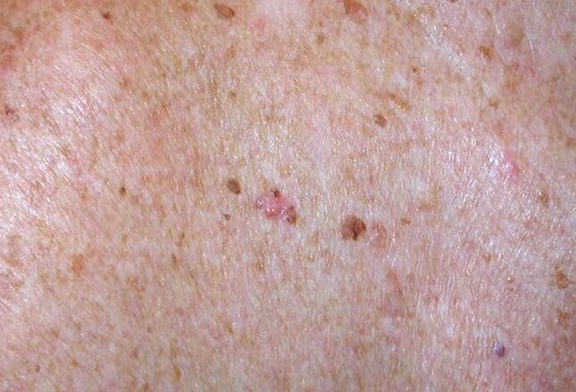 Mole or Melanoma? Test Yourself With These Suspicious Lesions