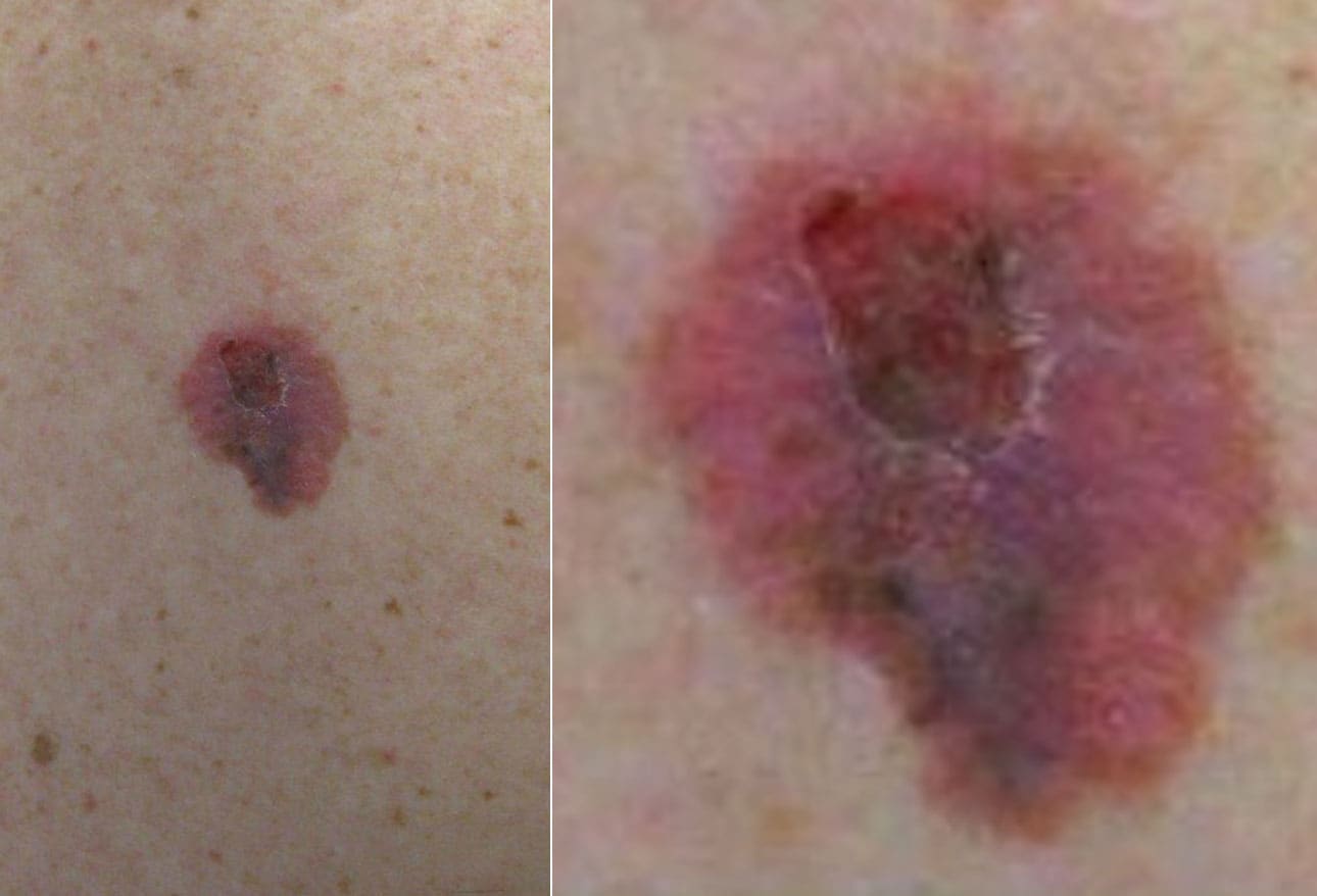 Mole or Melanoma? Test Yourself With These Suspicious Lesions