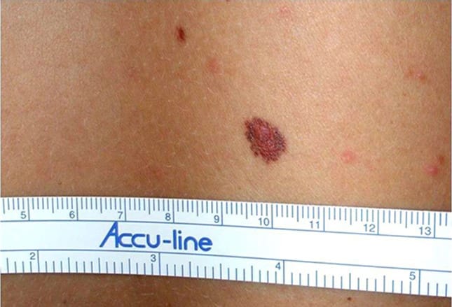 Mole or Melanoma? Test Yourself With These Suspicious Lesions