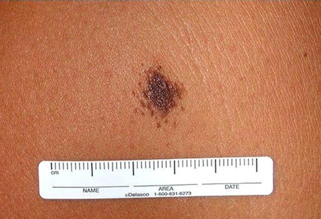 Mole or Melanoma? Test Yourself With These Suspicious Lesions
