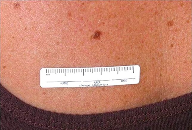 Mole or Melanoma? Test Yourself With These Suspicious Lesions