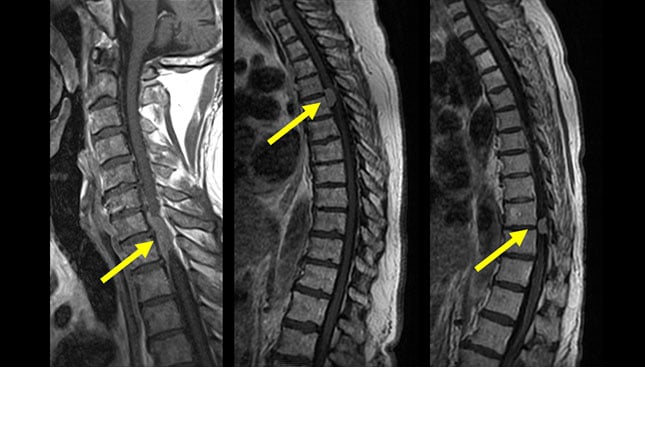 Meningioma: Characteristics and Surgical Treatment