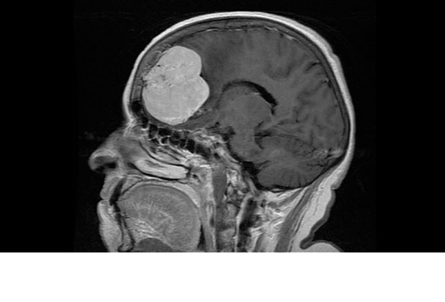Meningioma: Characteristics and Surgical Treatment
