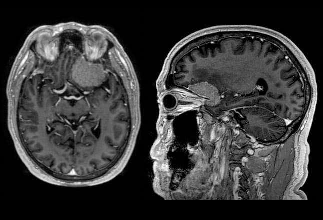Meningioma Characteristics And Treatment