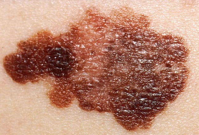 Cutaneous Clues to Diagnosing Metastatic Cancer