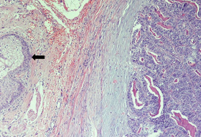 Cutaneous Clues to Diagnosing Metastatic Cancer