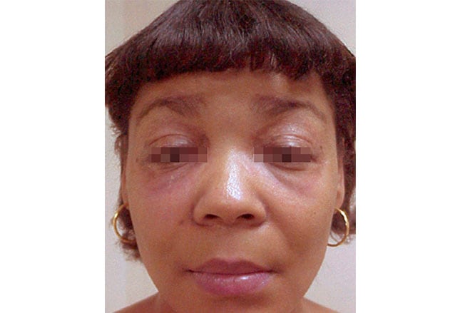 Cutaneous Clues to Diagnosing Metastatic Cancer