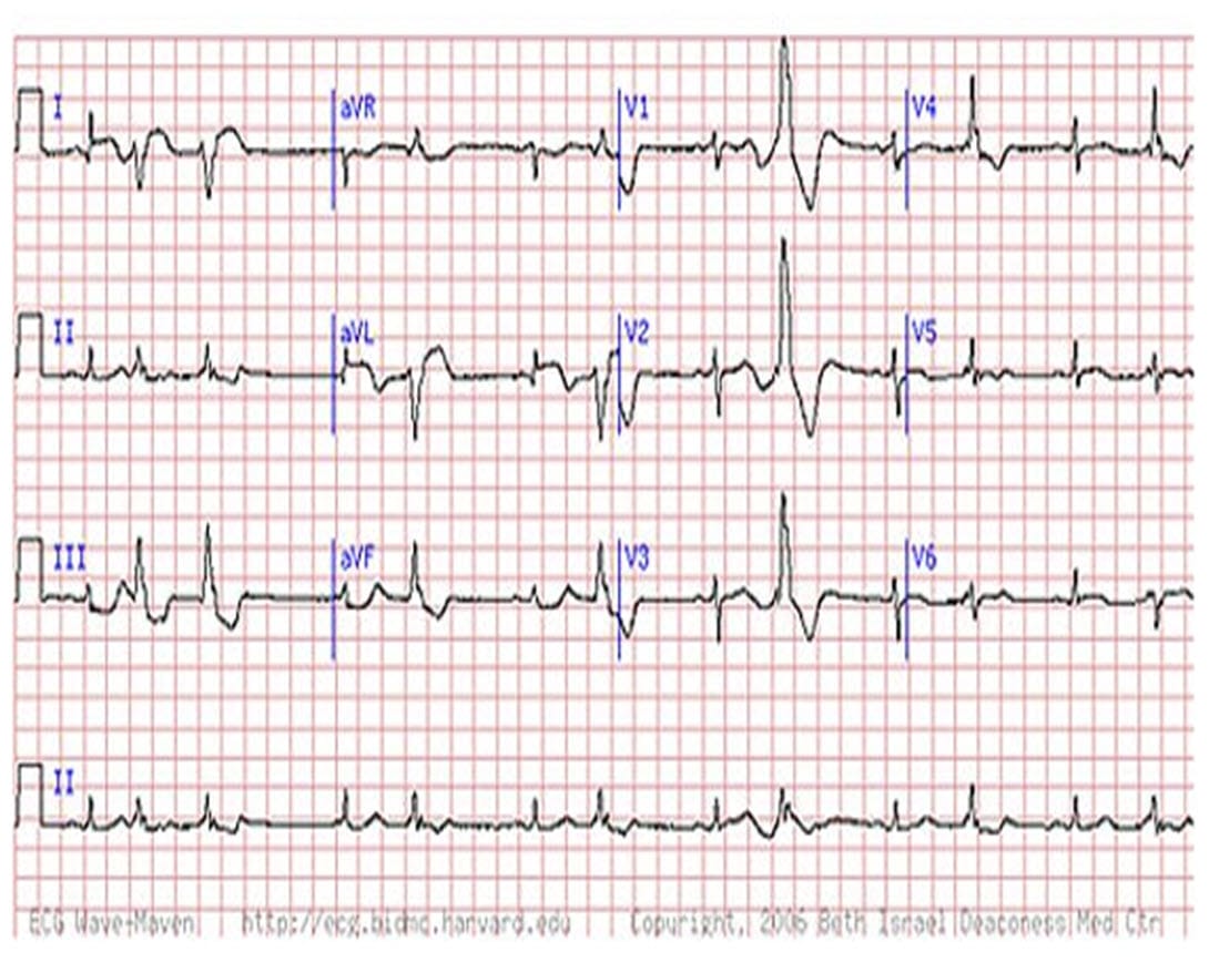 Are You Missing Subtle MI Clues on ECGs? Test Your Skills
