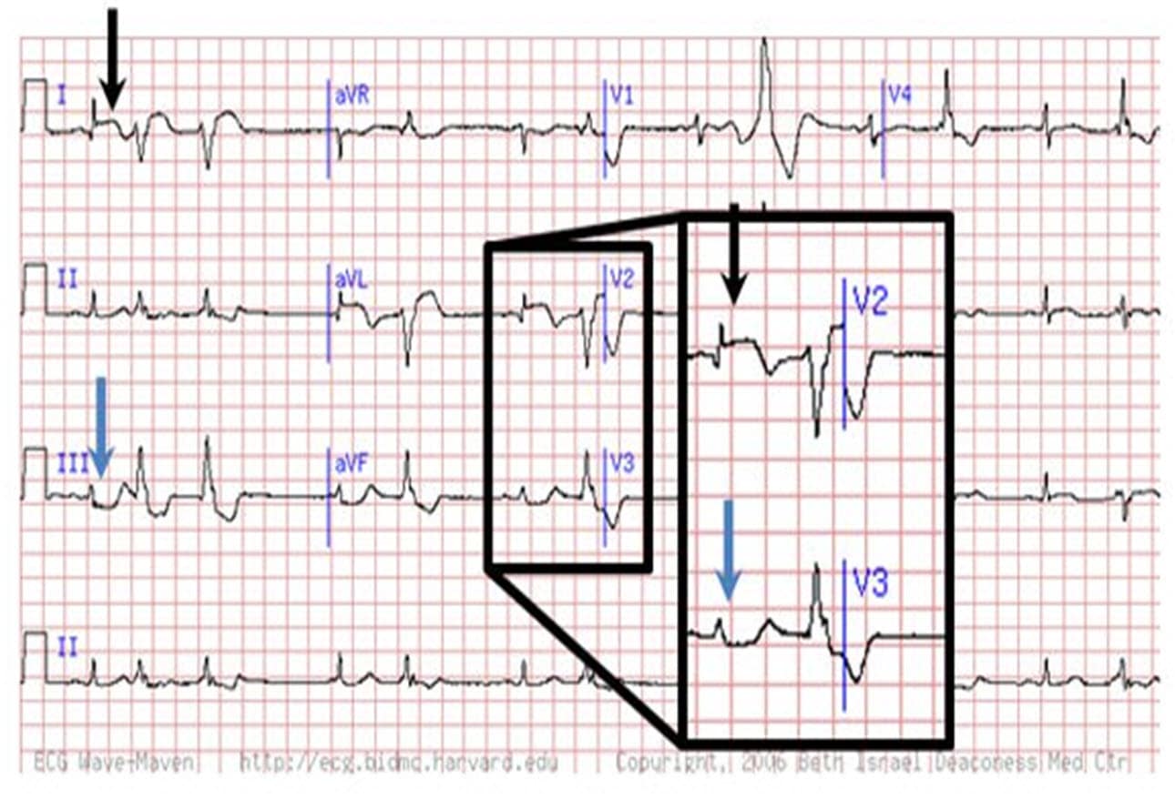 Are You Missing Subtle MI Clues on ECGs? Test Your Skills