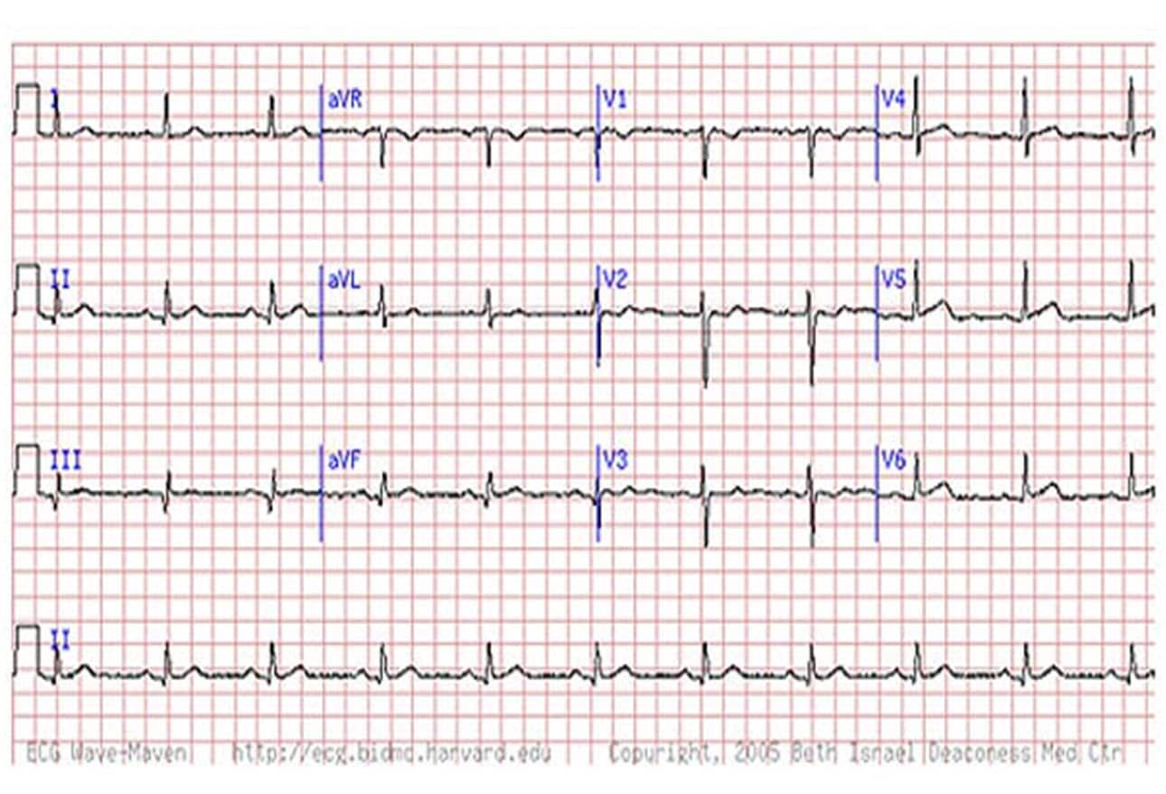 Are You Missing Subtle MI Clues on ECGs? Test Your Skills