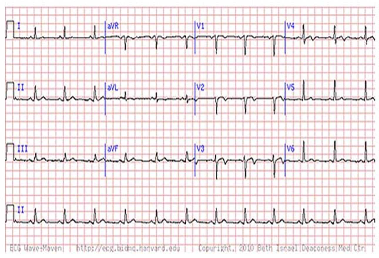 Are You Missing Subtle MI Clues on ECGs? Test Your Skills