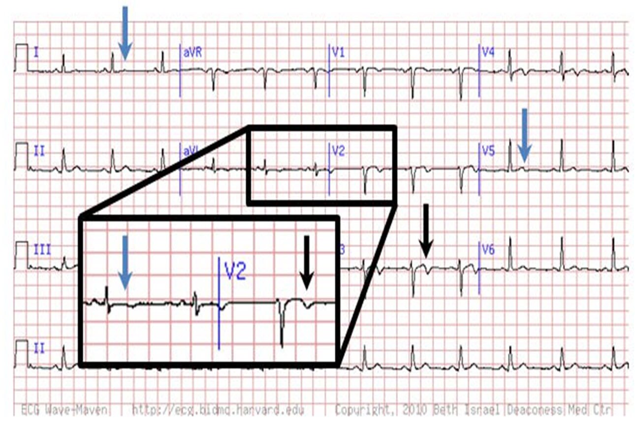 Are You Missing Subtle MI Clues on ECGs? Test Your Skills