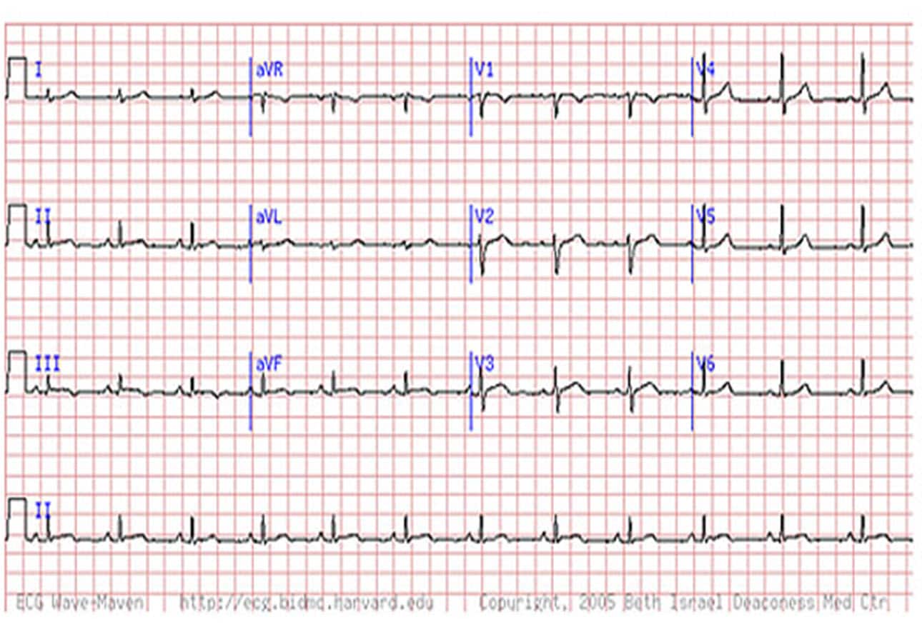 Are You Missing Subtle MI Clues on ECGs? Test Your Skills
